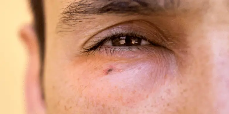 How To Treat A Bee Sting: Symptoms, Treatments & More