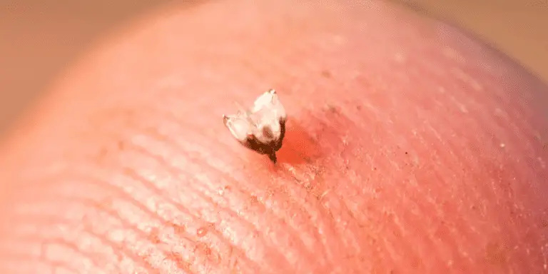 How To Treat A Bee Sting: Symptoms, Treatments & More