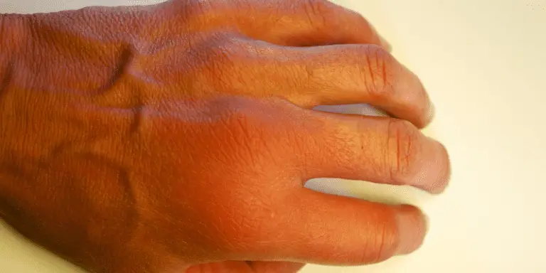 How To Treat A Bee Sting: Symptoms, Treatments & More