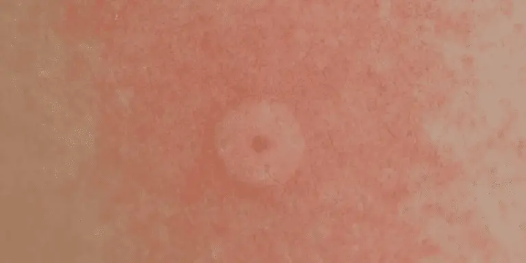 How To Treat A Bee Sting: Symptoms, Treatments & More